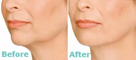 Silhouette Soft Lift Lower Jaw Line Contouring Treatment Call 01 2325528