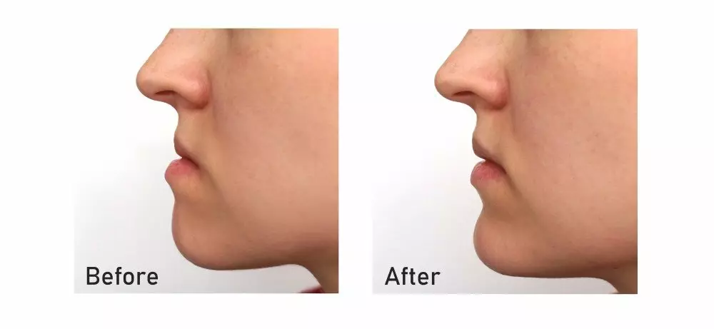 Botox Lower Jaw Line Definition Treatment Available At Excellence Medical