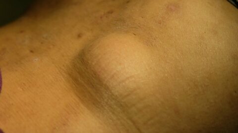 Lipoma Removal Treatment Available At Excellence Medical 01 2325528