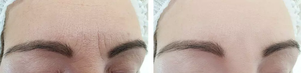 Forehead Lines & Frown Lines Dermal Filler Treatment